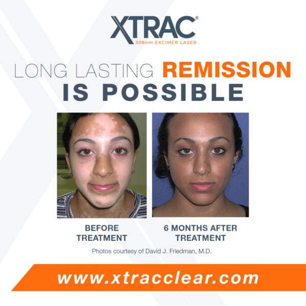 XTrac Laser | XTrac Laser Treatment by Las Vegas Dermatology®
